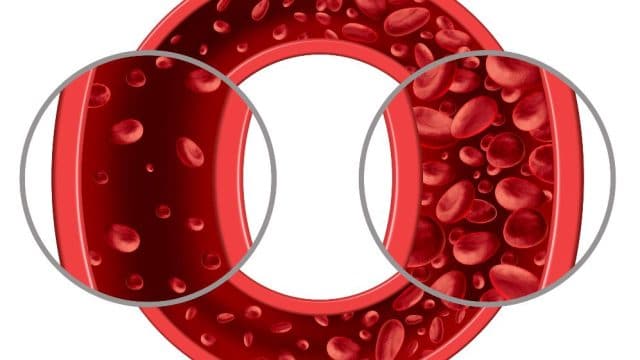 Ενδοφλέβια Θεραπεία με Σίδηρο σε Ασθενείς με Σιδηροπενική Αναιμία ...