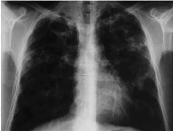 Φυματίωση: Διάγνωση και Θεραπεία - Current Medical Journal