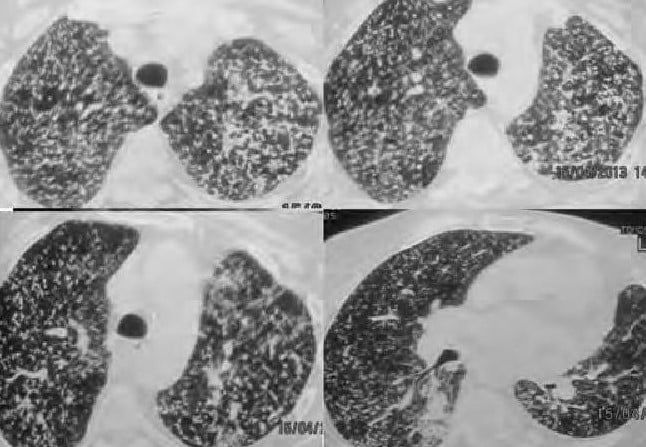 Φυματίωση: Διάγνωση και Θεραπεία - Current Medical Journal